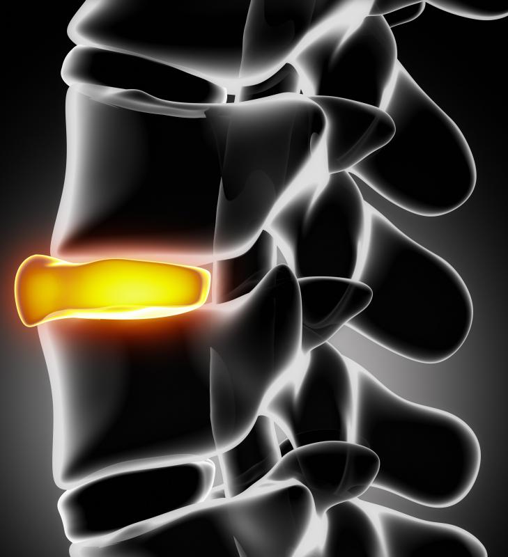 What Is Bulging Disc Surgery with Pictures What Is Bulging Disc Surgery with Pictures