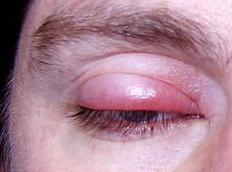 Staph Infection In Eye
