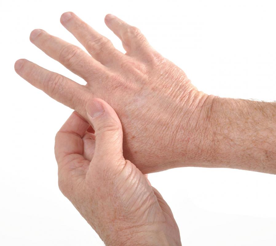 Withered Arm Syndrome